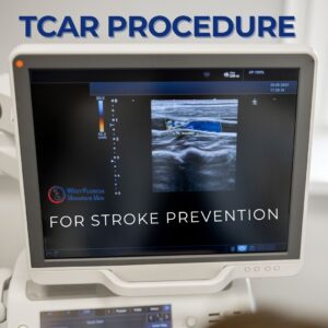 TCAR Procedure for Stroke Prevention - What You Need to Know